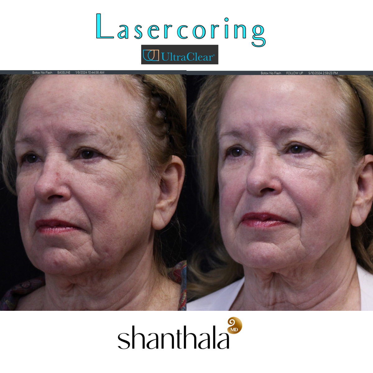 Laser Coring Before & After Photos Boston- Dr. Shanthala