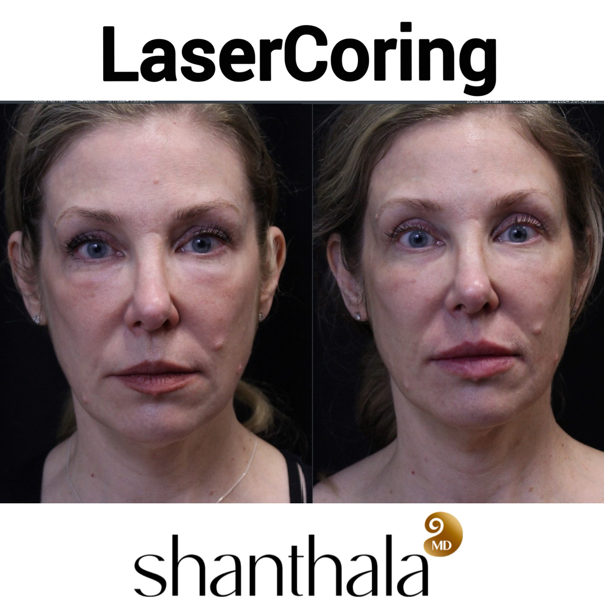Laser Coring Before & After Photos Boston- Dr. Shanthala
