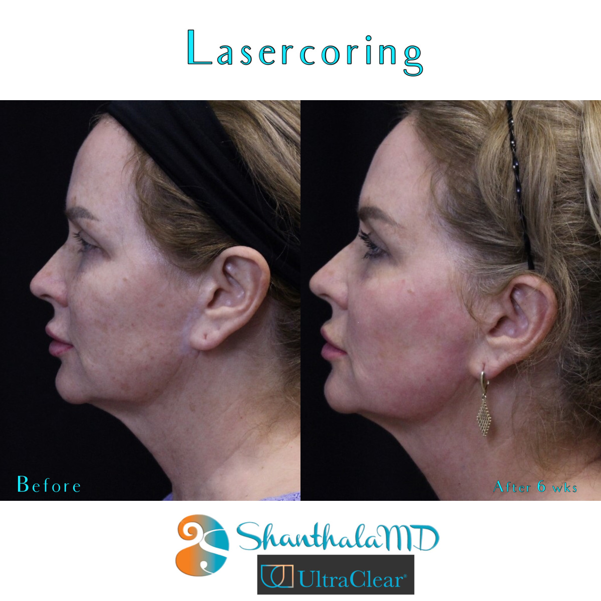Laser Coring Before & After Photos Boston- Dr. Shanthala