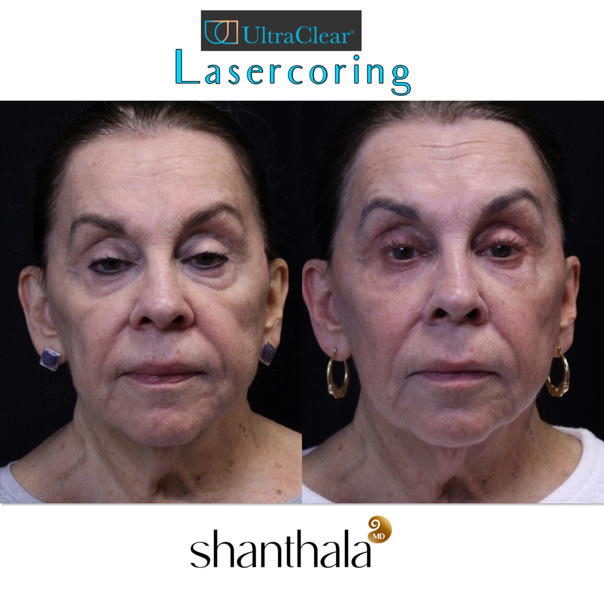 Laser Coring Before & After Photos Boston- Dr. Shanthala