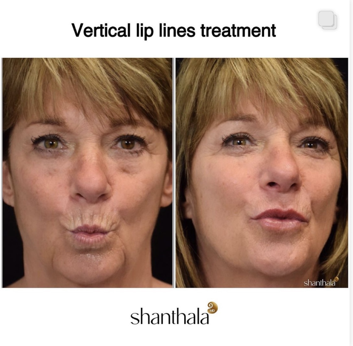 Erase Vertical lip lines - Smoker lines Treatment Boston