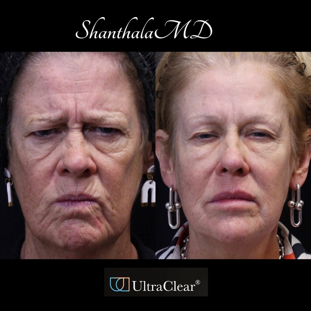 Laser Coring Before & After Photos Boston- Dr. Shanthala