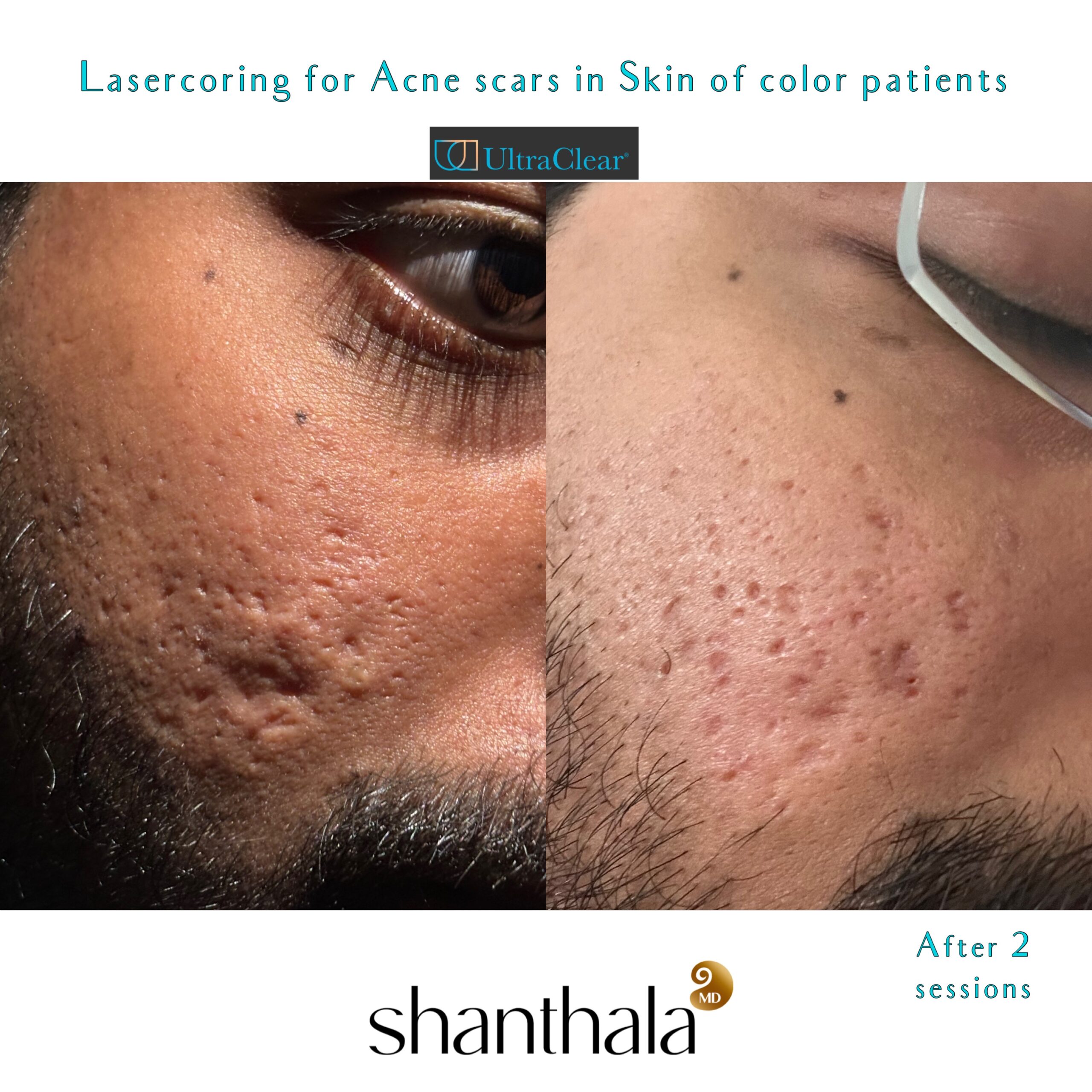 How to treat Acne Scars in Dark skin - Laser-Coring & Scars