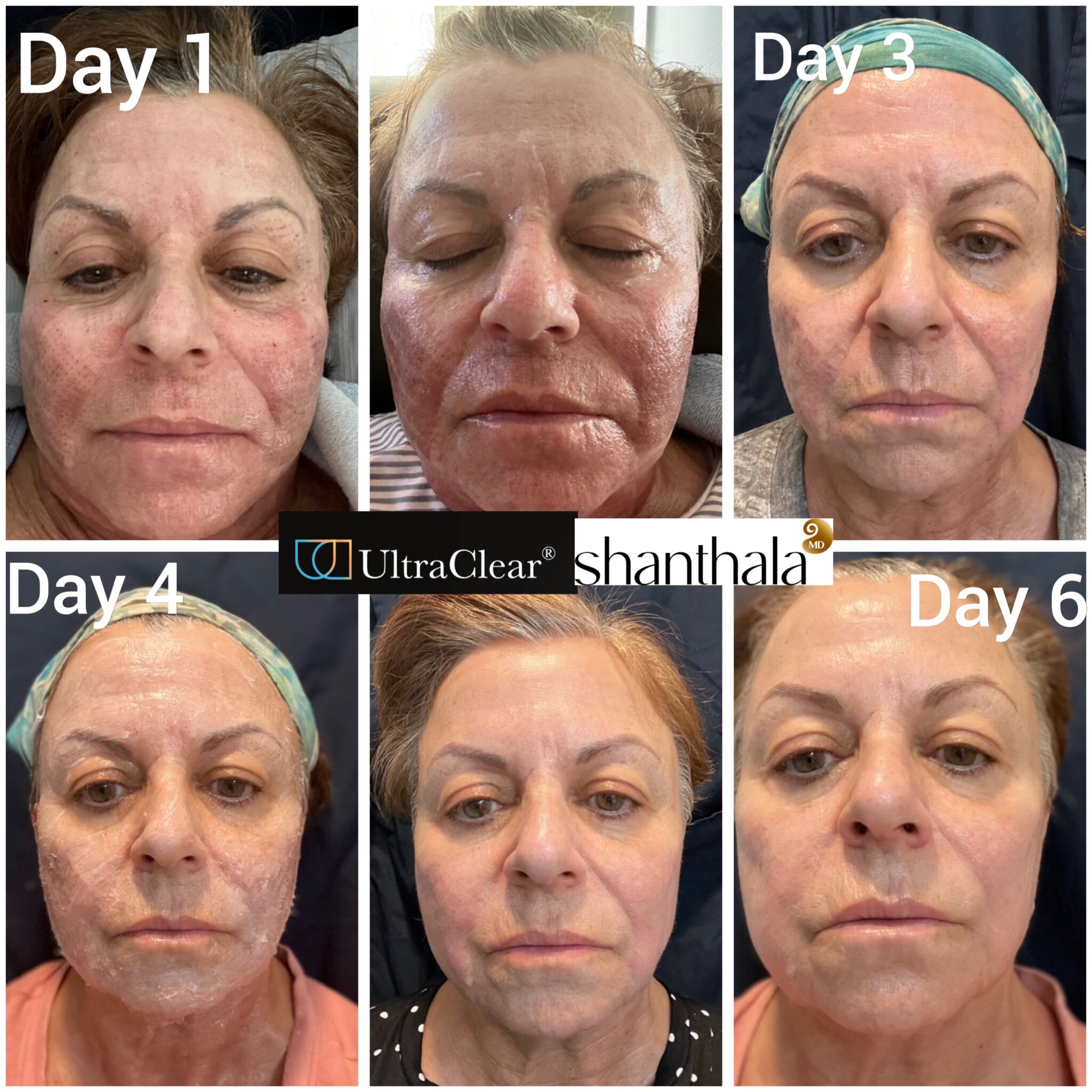Skincare After Laser-Coring - Post UltraClear Laser Protocol