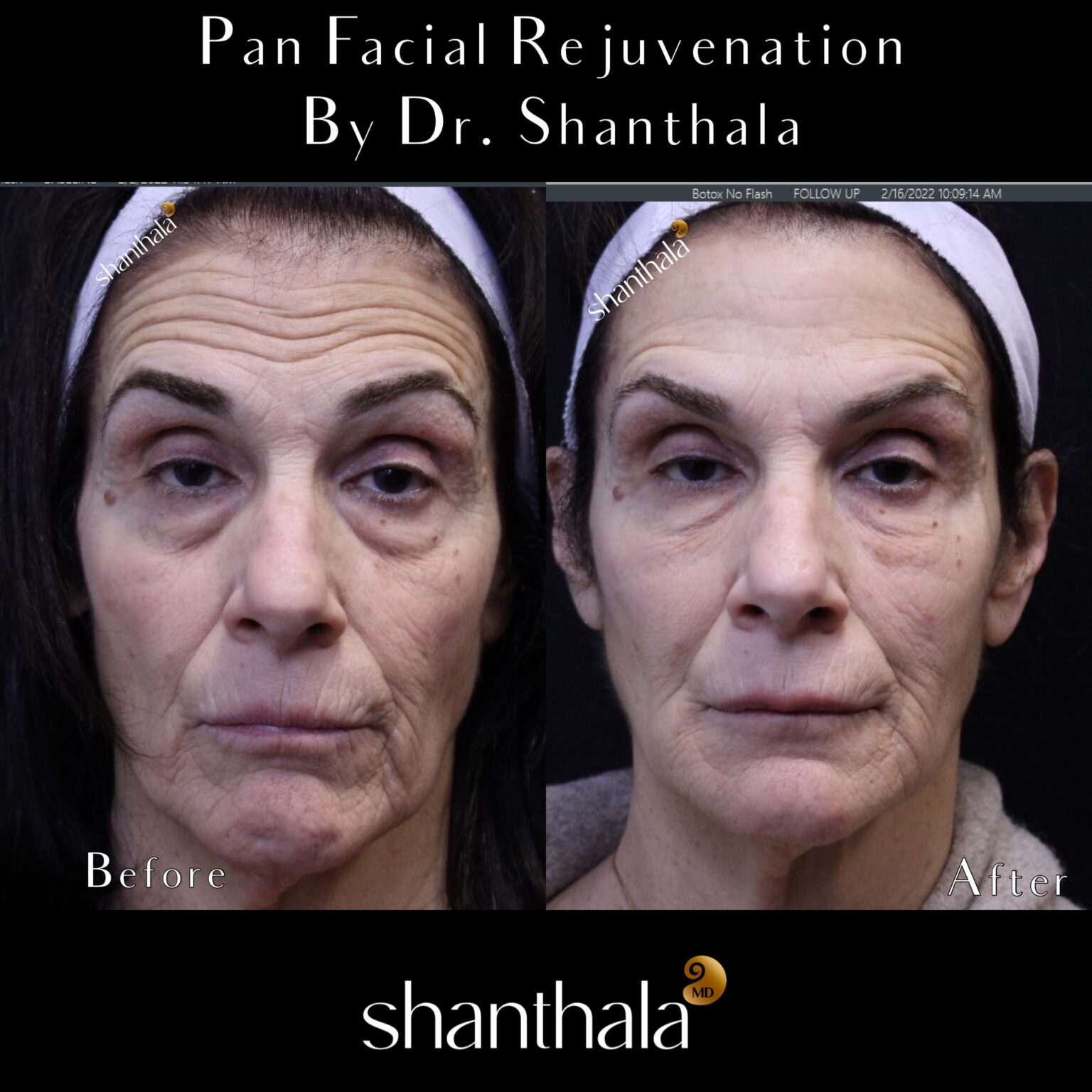 PRP/PRF & Vampire procedures Boston- What can go wrong?