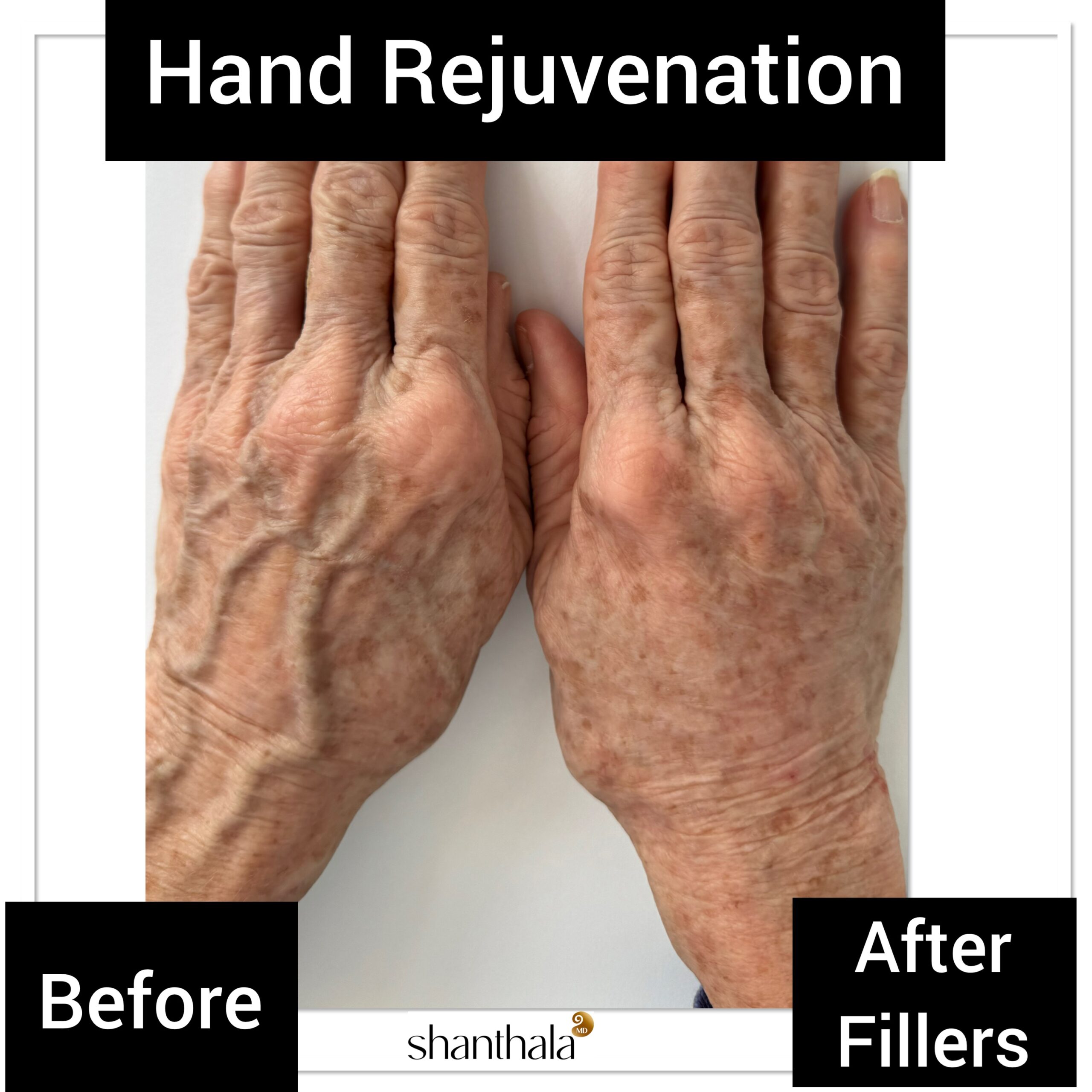 Hand Rejuvenation Boston - Laser & Fillers for aged Hands