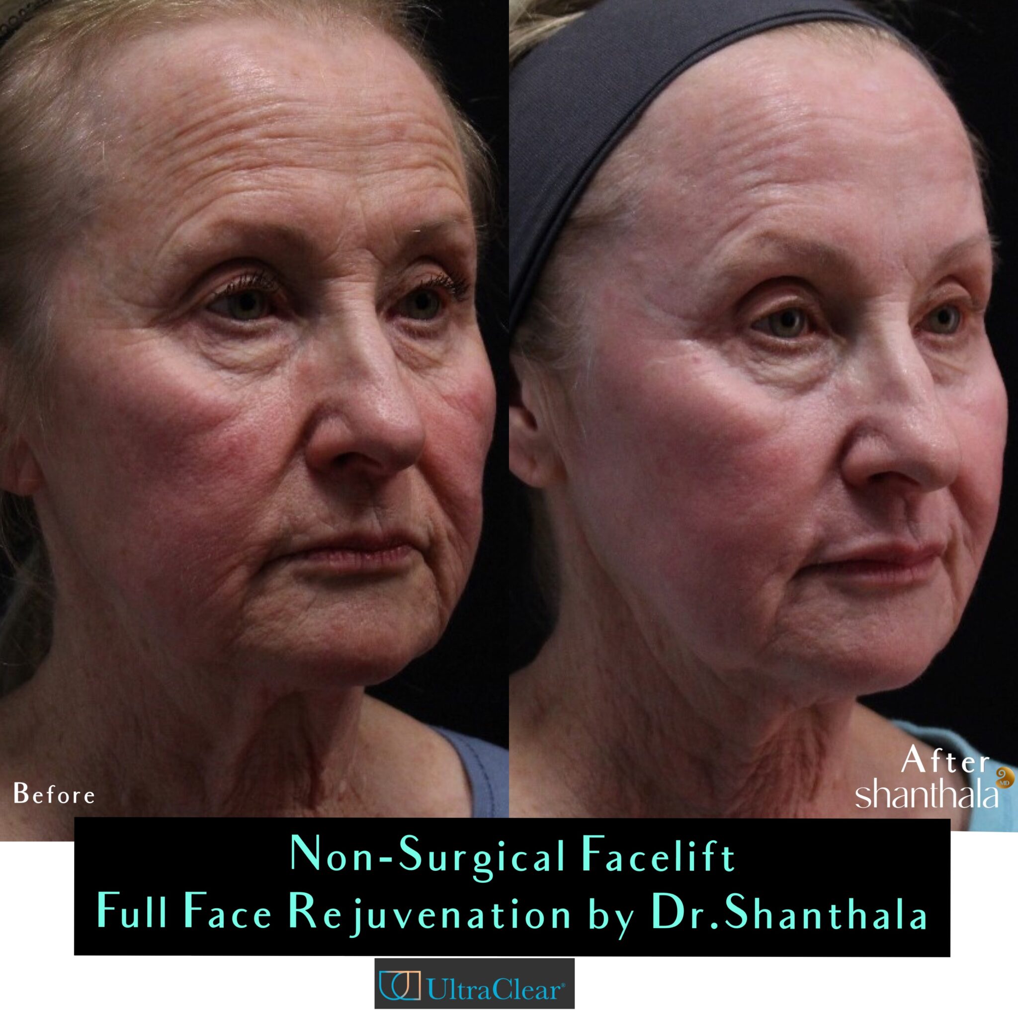 Ellacor Tissue Coring vs. Laser Enabled Tissue Coring